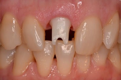 Implant Crowns in West and North Vancouver For Oral Health